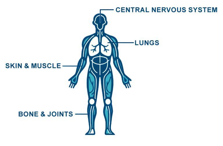 COCCI SYMPTOMS - Mycology Advocacy, Research & Education (MyCARE)